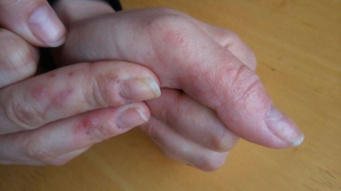 Мази для заживления ран и трещин быстрого действия – 9 лучших средств