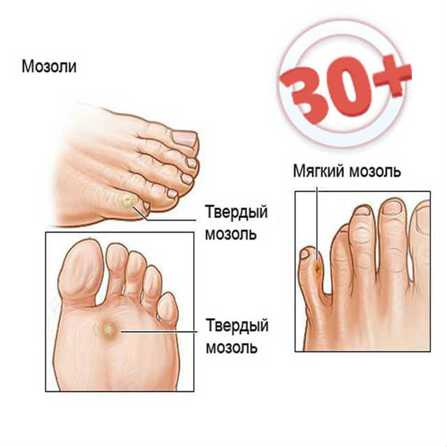 Как избавиться от мозолей на пальцах ног: способы лечения и решения ...