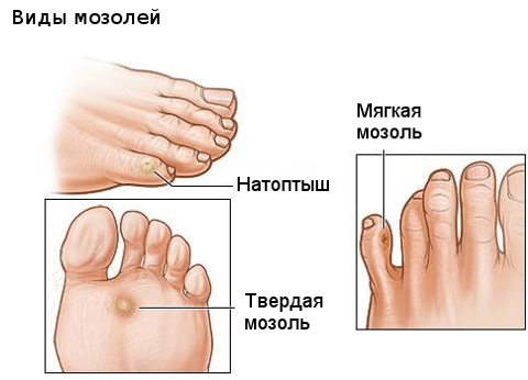 Как избавиться от мозолей на пальцах ног: способы лечения и решения ...